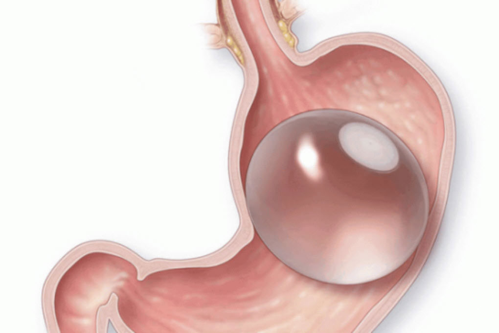 Ontario Bariatric Weight Loss Surgery | Gastric Sleeve, Bypass Surgeon