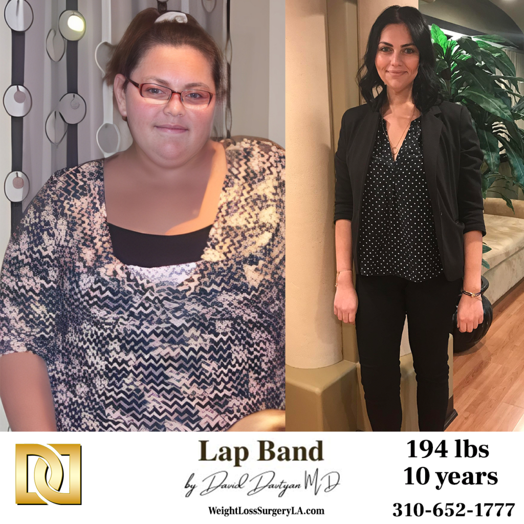 Aleksandra’s Lap-Band Transformation | Dr. David Davtyan, Los Angeles