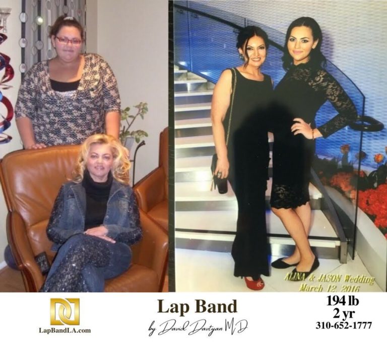 Weight Loss Surgery Before and After Gallery | The Weight Loss Surgery ...