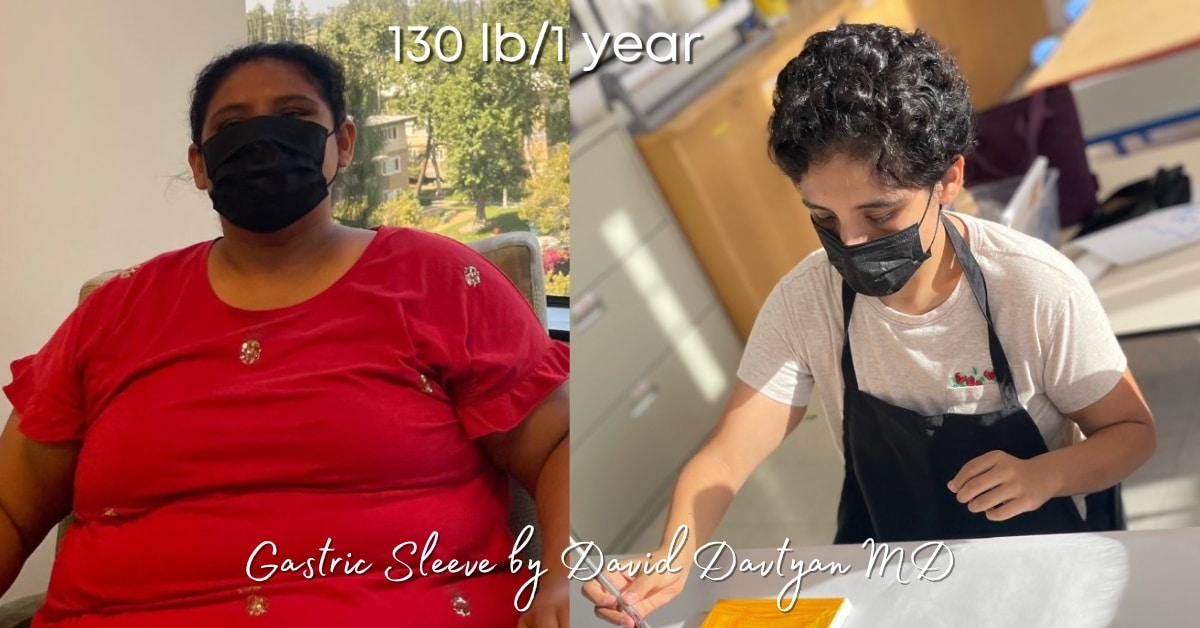 Gastric Sleeve Surgery in Los Angeles