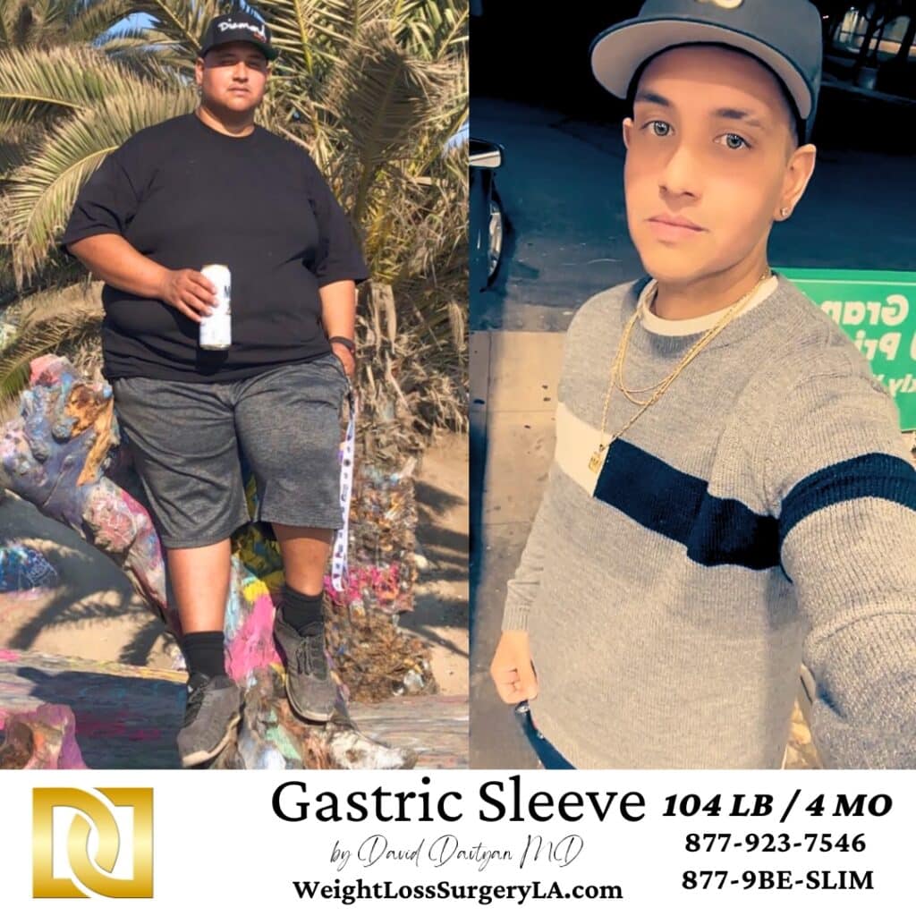 Gastric Sleeve Before and After Photos